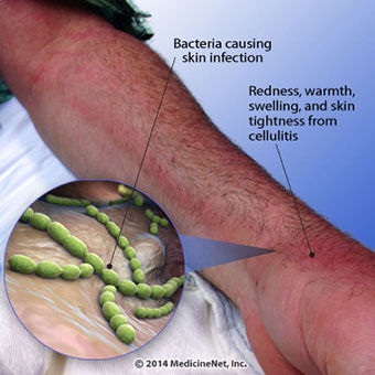 The Walking Wounded Among Us. Why You Should Take Sepsis More Seriously.