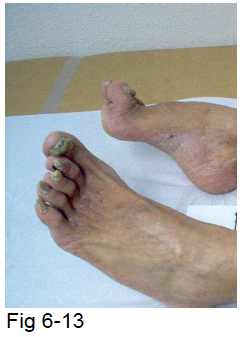 Chapter 6 – Bunions, corns, calluses and ulcers | Serve the People