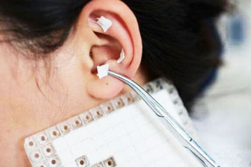 Ear Seeds Acupuncture