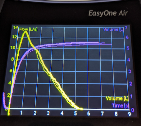 Spirometry Testing Explained