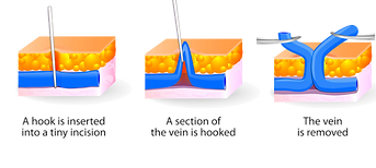 Venous Insufficiency| Varicose veins | Houston Vascular