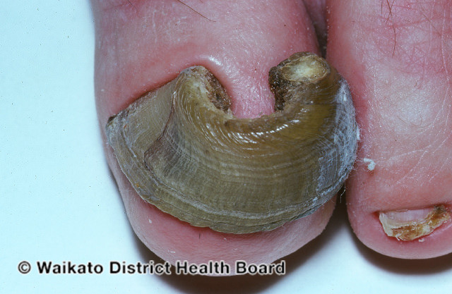 Toenail Problems Phoenix | 20 Common Nail Issues & Treatment