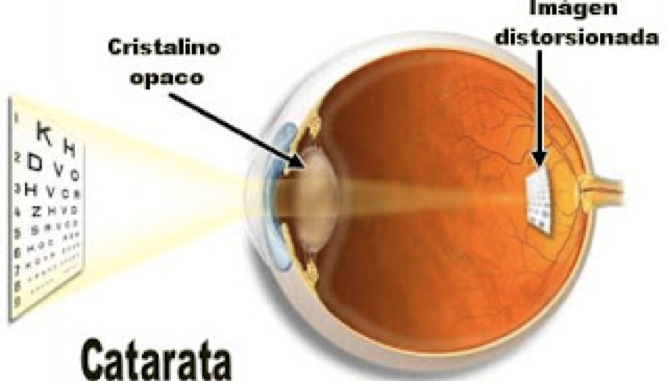 ¿Qué son las Cataratas?