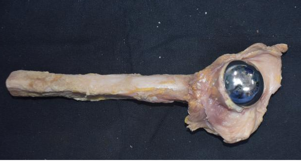 The Journey of a Bone: From Donation to Healing Lives