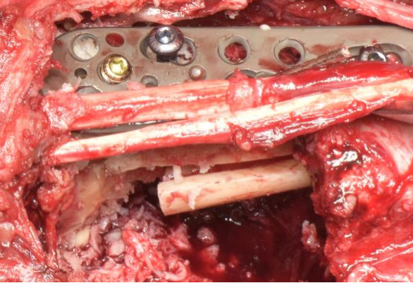 The Journey of a Bone: From Donation to Healing Lives