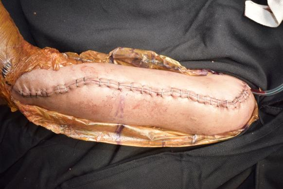 The Journey of a Bone: From Donation to Healing Lives