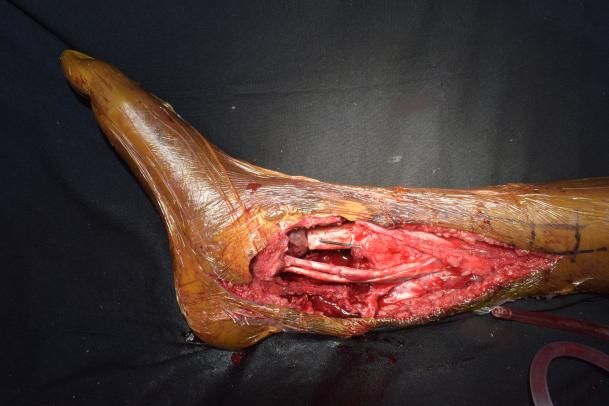 The Journey of a Bone: From Donation to Healing Lives