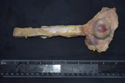 The Journey of a Bone: From Donation to Healing Lives