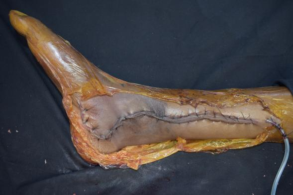 The Journey of a Bone: From Donation to Healing Lives