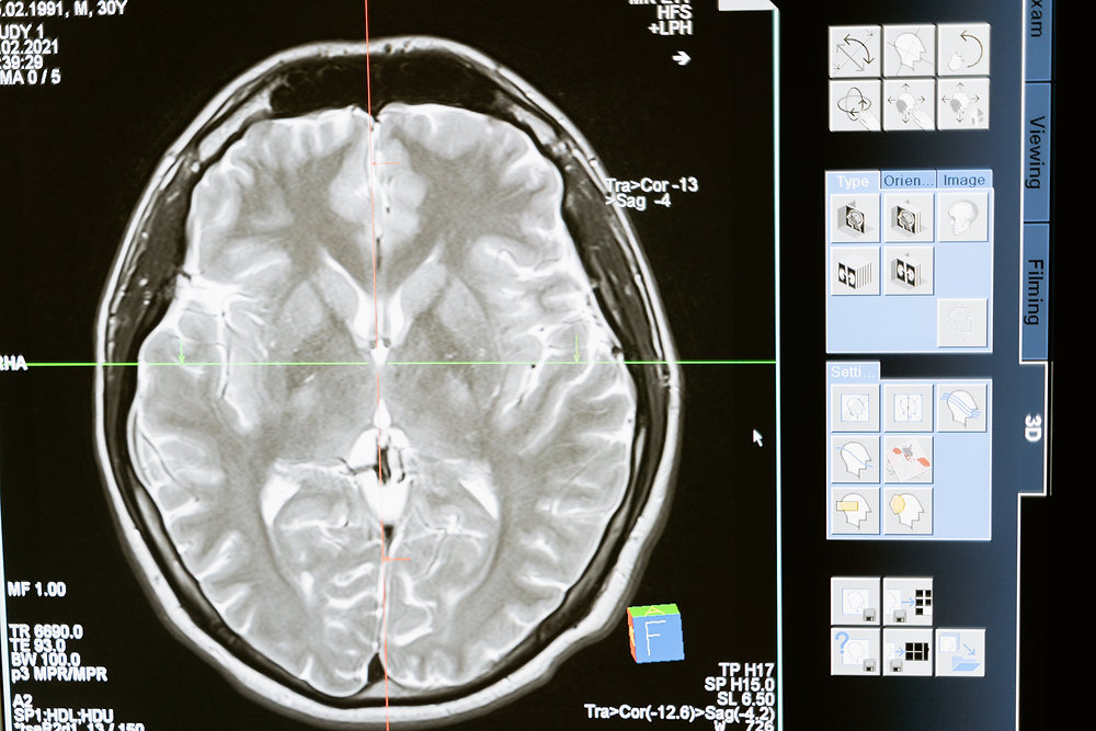 Brain Tumor Imaging Advancements: The Next Frontier in Diagnosis and ...