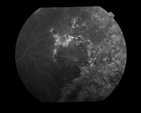 מחלת בכצ'ט Behçet'sn