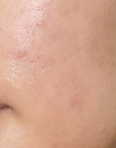 Why Vivace Ultra® RF Microneedling is a Game-Changer for Active Acne ...