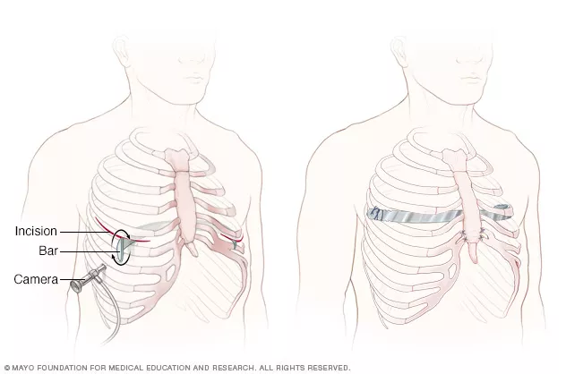 Pectus Notebook | Home