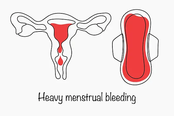 menstrual bleeding heavy