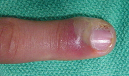 Infections of the Hand