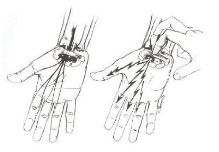 CARPAL TUNNEL SYNDROME & OTHER COMPRESSION NEUROPATHIES OF THE UPPER ...