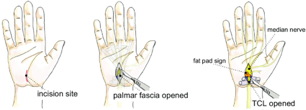 CARPAL TUNNEL SYNDROME & OTHER COMPRESSION NEUROPATHIES OF THE UPPER ...