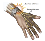 CARPAL TUNNEL SYNDROME & OTHER COMPRESSION NEUROPATHIES OF THE UPPER ...