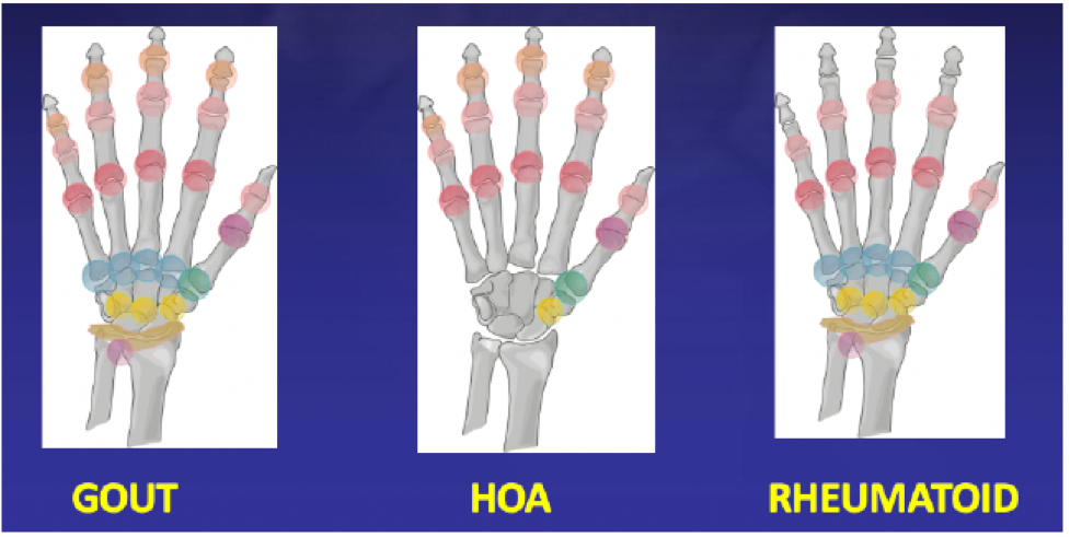 Hand Osteoarthritis