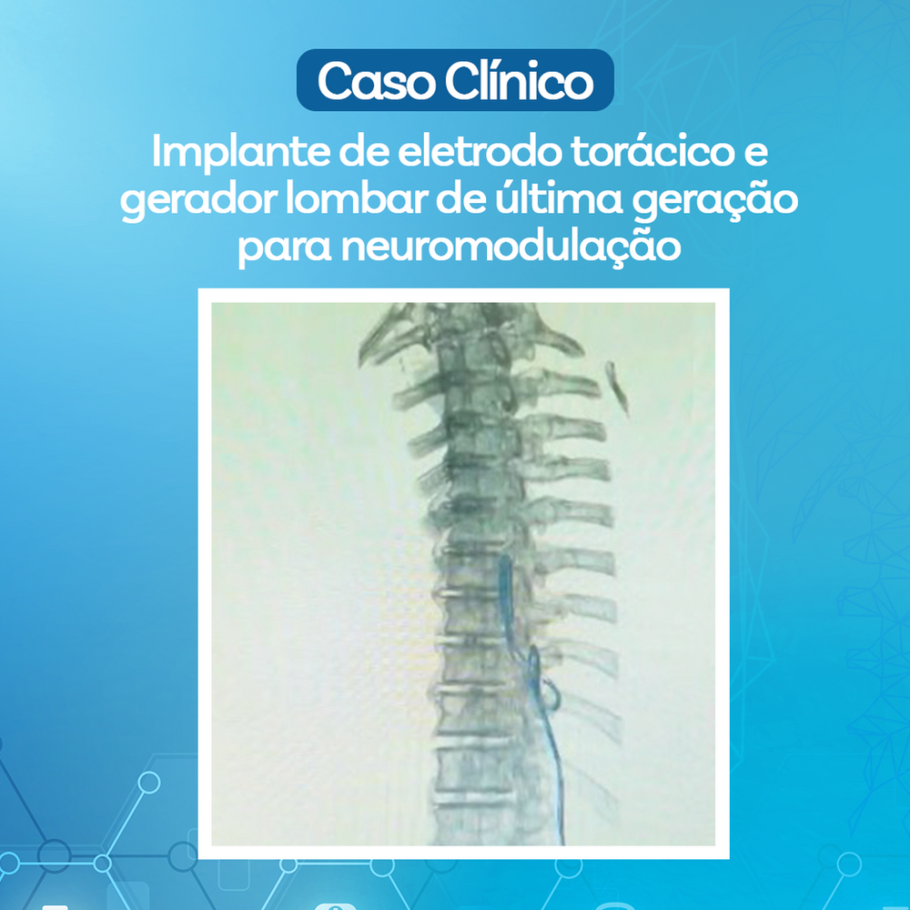 Implante de eletrodo torácico e gerador lombar de última geração para ...