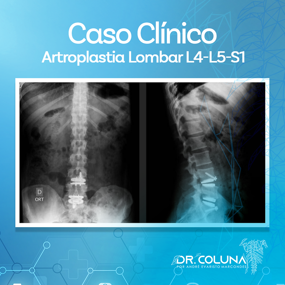 Comprometimento Axonal Crônico Em L5-s1 - RETOEDU