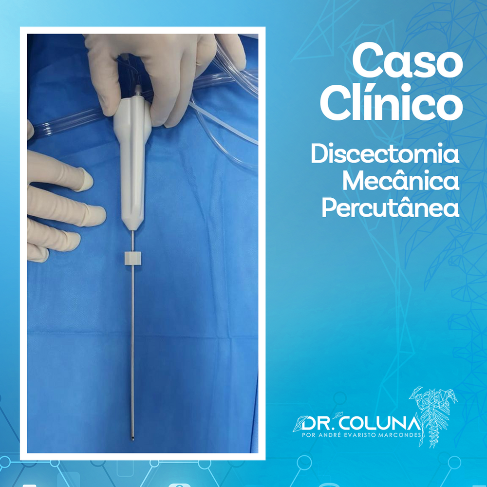 CASO CLÍNICO | Discectomia Mecânica Percutânea