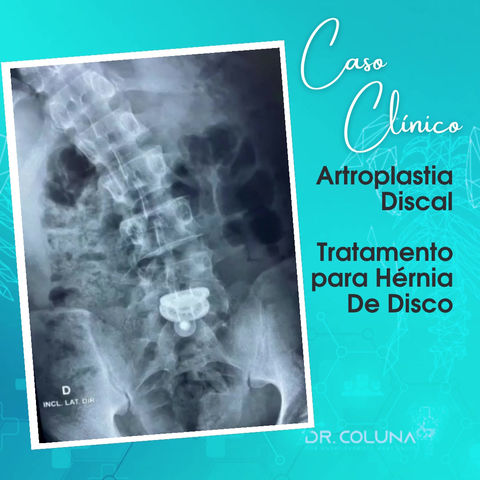 Artroplastia para tratamento de hérnia de disco extrusa