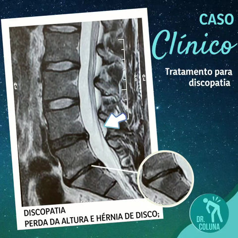 Tratamento para discopatia