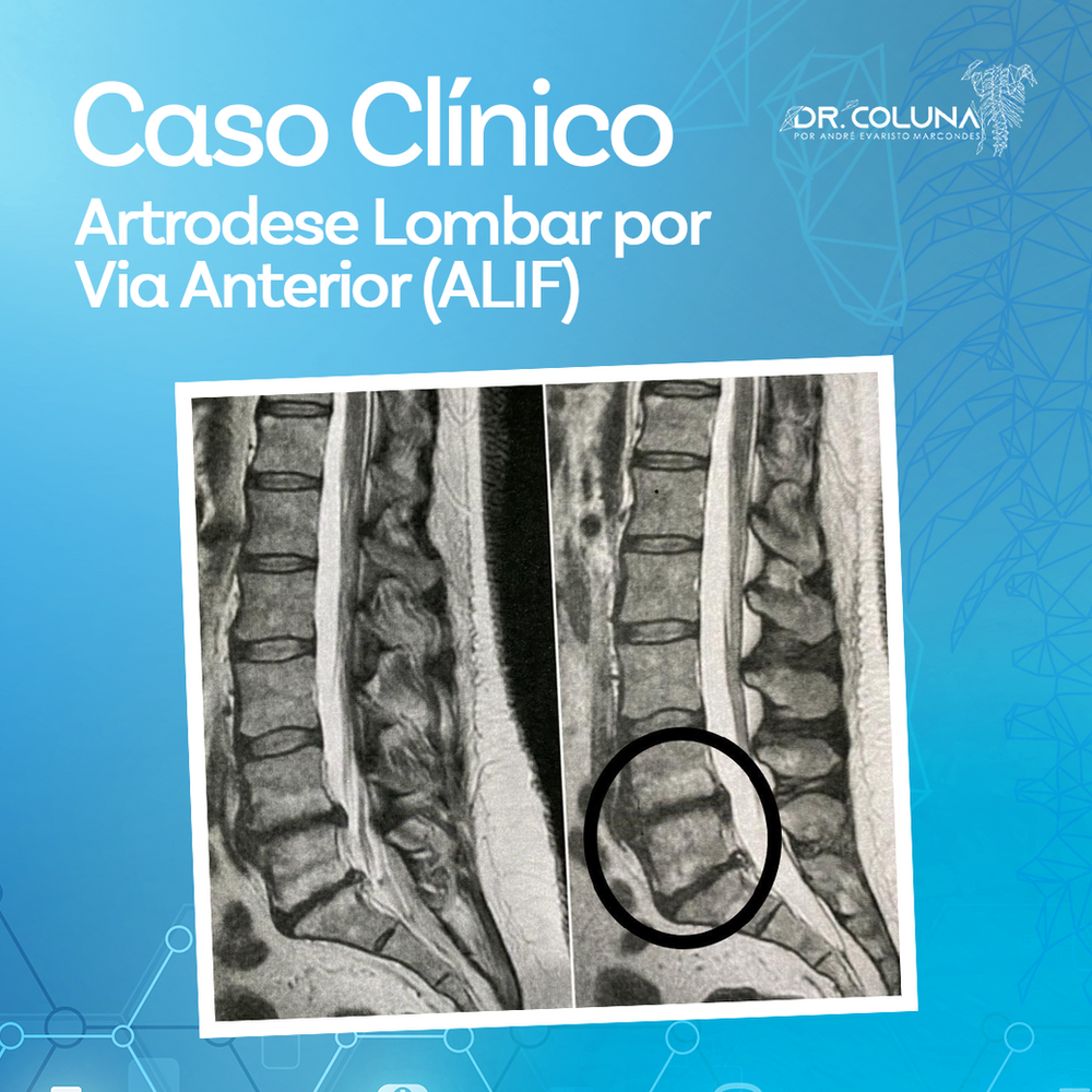 Artrodese Lombar por Via Anterior (ALIF)
