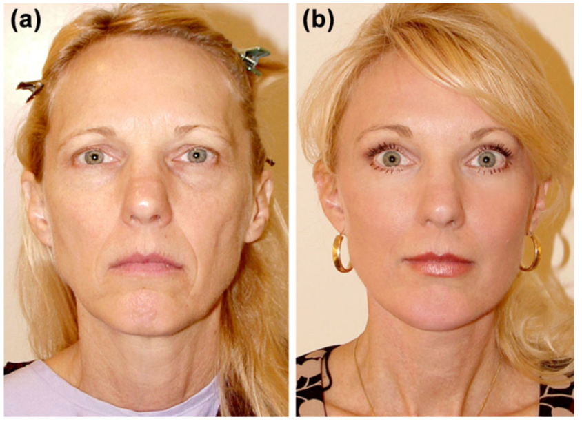 Facial Fat Grafting: Why, Where, How, and How Much?
