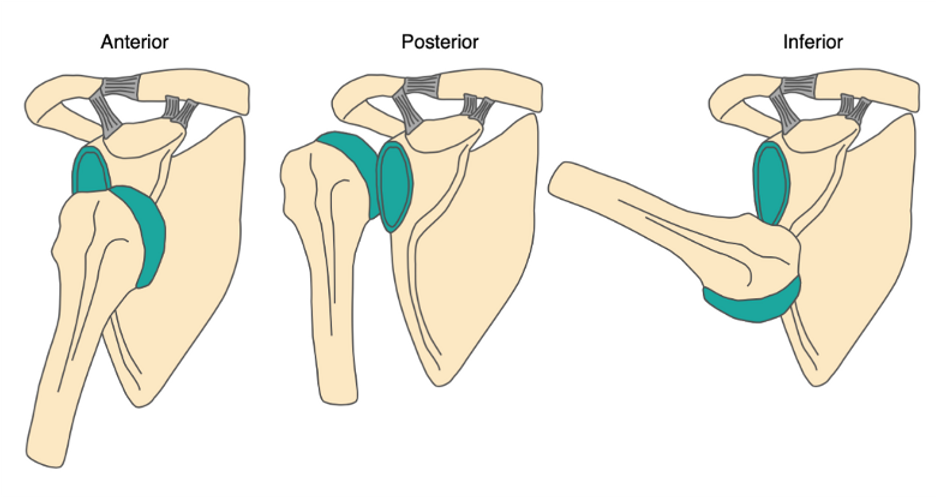 Understanding Shoulder Dislocations in Sports: Causes, Types, and Recovery