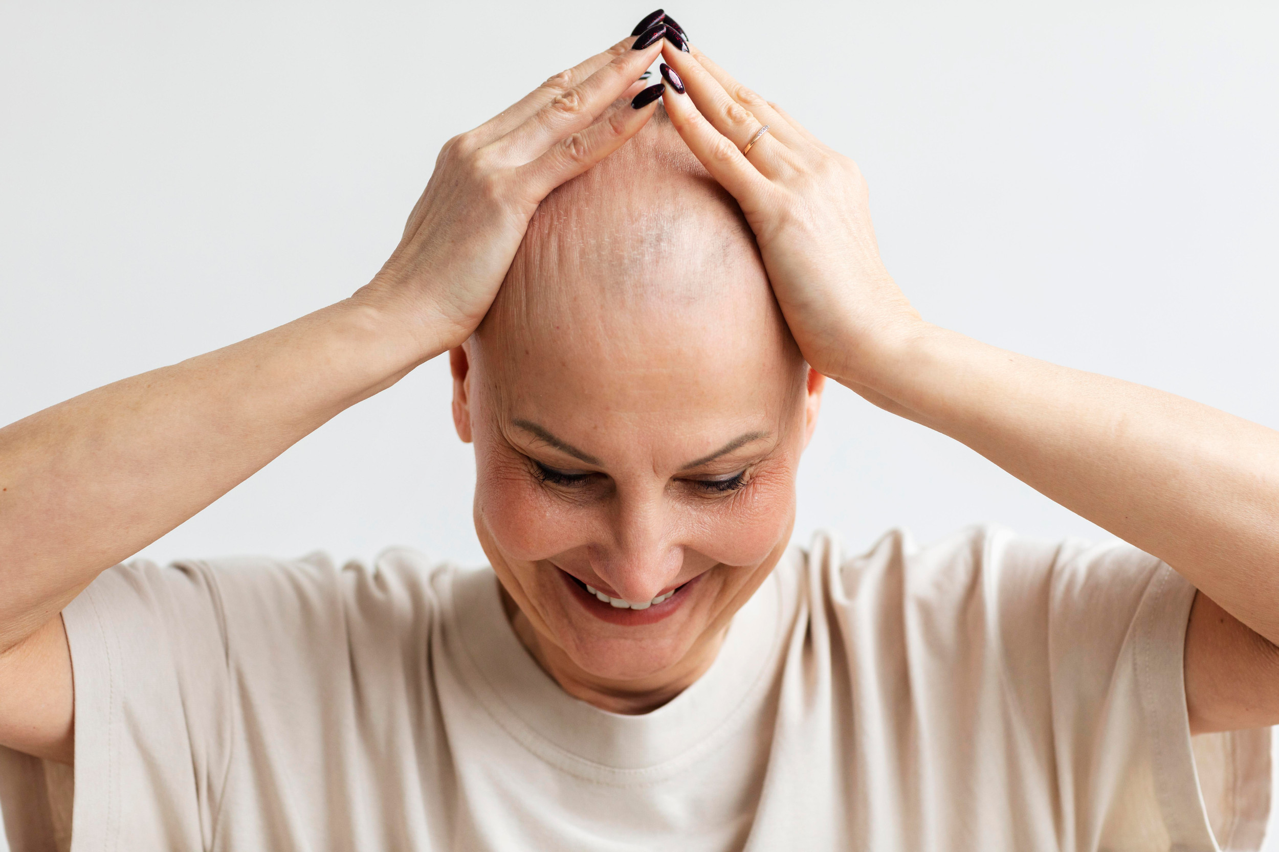 Do you suffer from patchy baldness, alopecia areata? - Intermedica Clinic