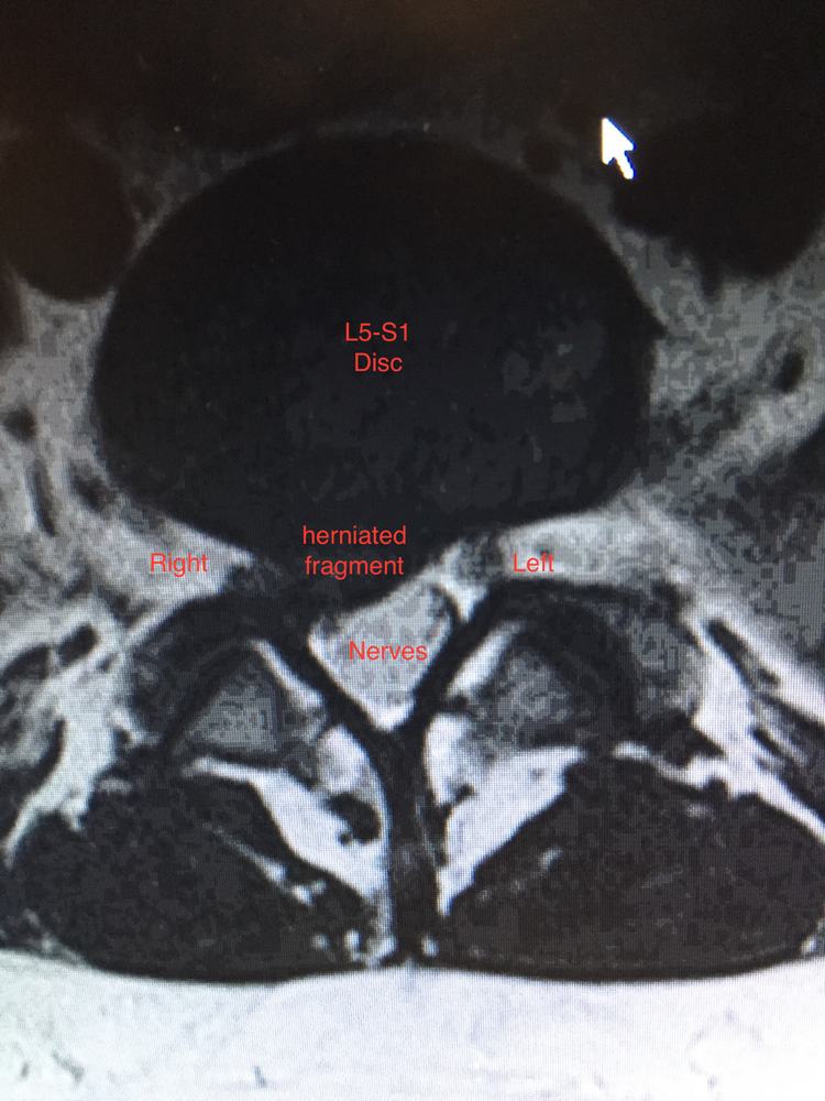 Microscopic Discectomy
