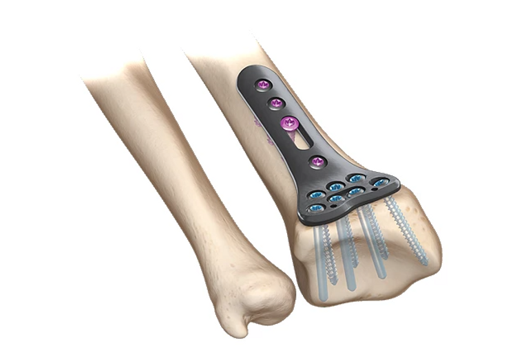 Stryker VariAx Distal Radius Locking Plate System. Catalog #53-27716E