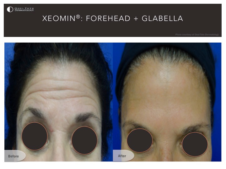 botox gallery | Osei-Tutu Dermatology & Hair Restoration