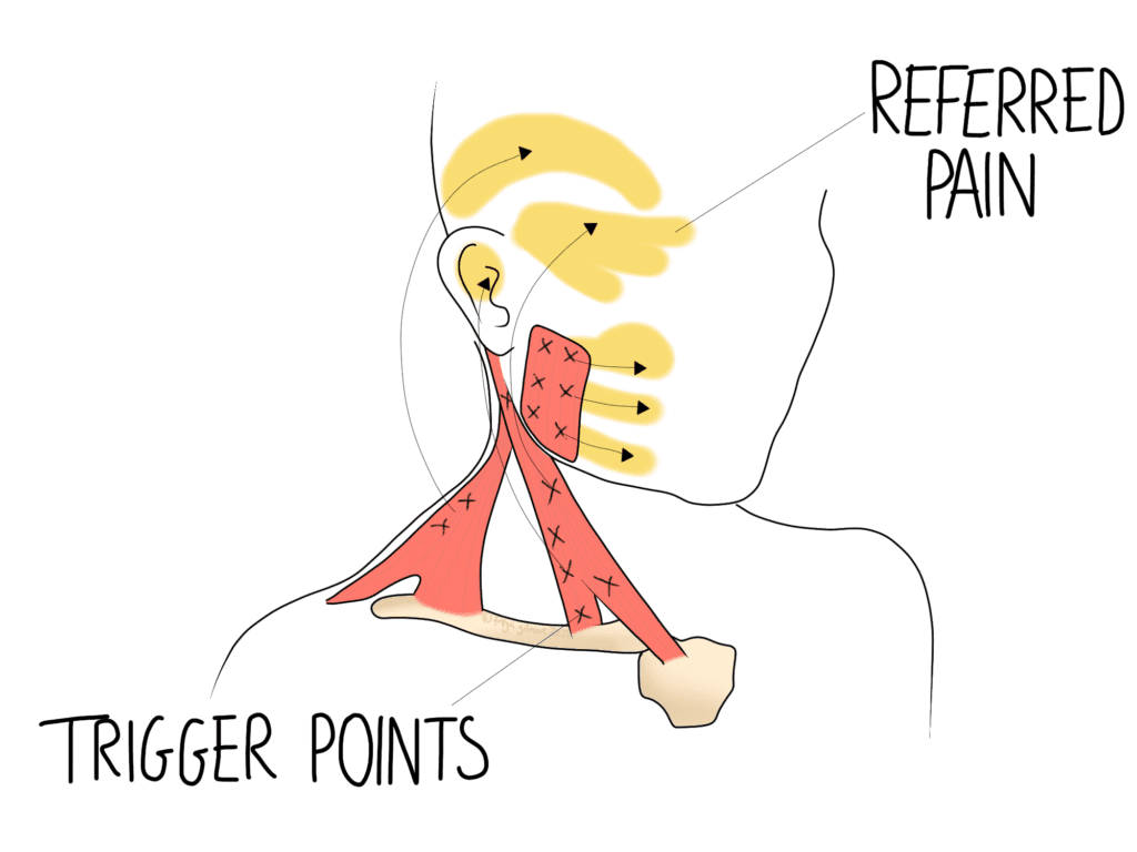 Trigger Points & Treatment at Eastbourne Osteopathy