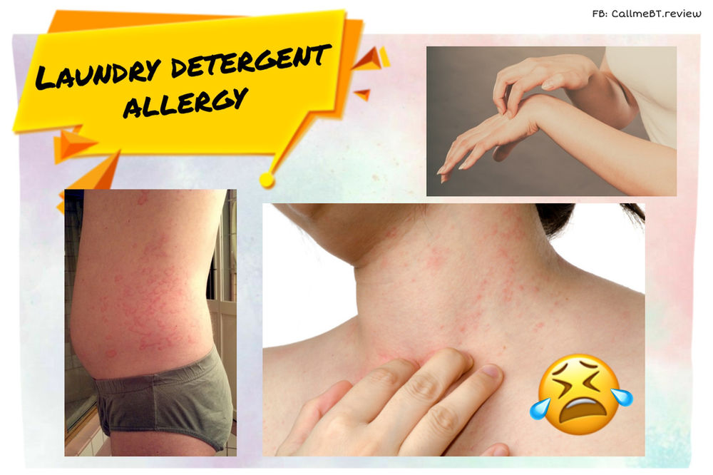 Laundry detergent allergy แก้ได้ที่ตัวเรา I Call me BT
