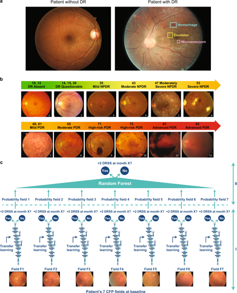Diabetic Retinopathy Screening - The Rise of Artificial Intelligence in ...
