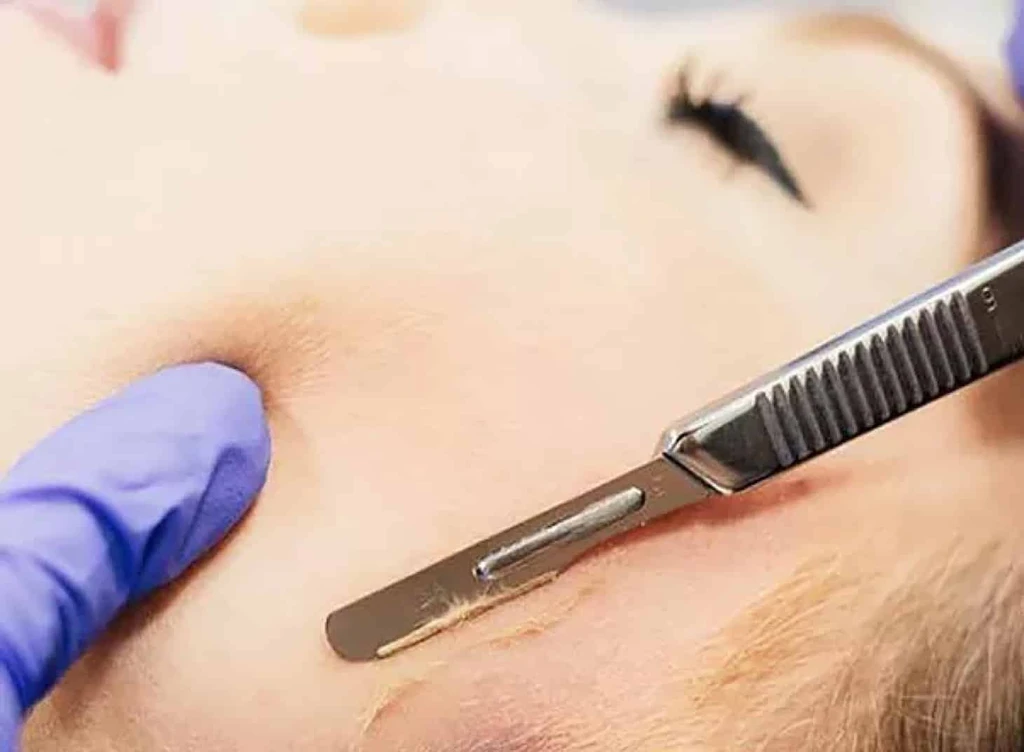 What is Dermaplaning?