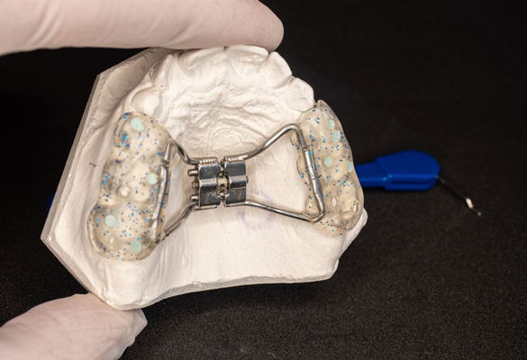 Expanders and Retainers in Mississauga | Dr Rob Pasch DDS MSc General ...