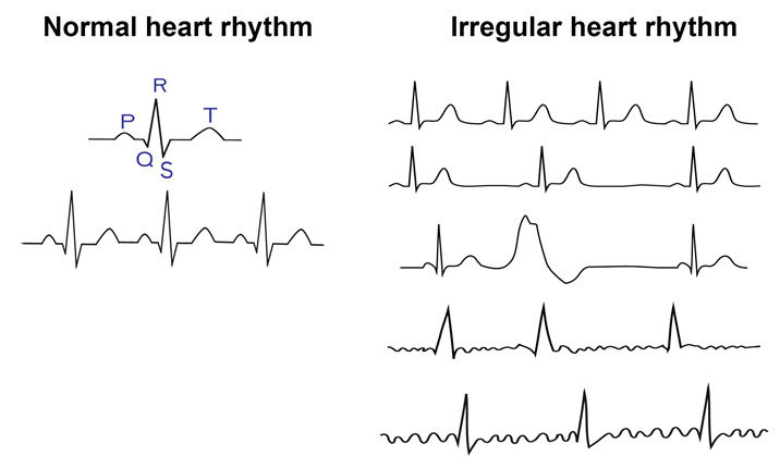Get ready for an Cardiac ablation to correct irregular heart rhythm ...