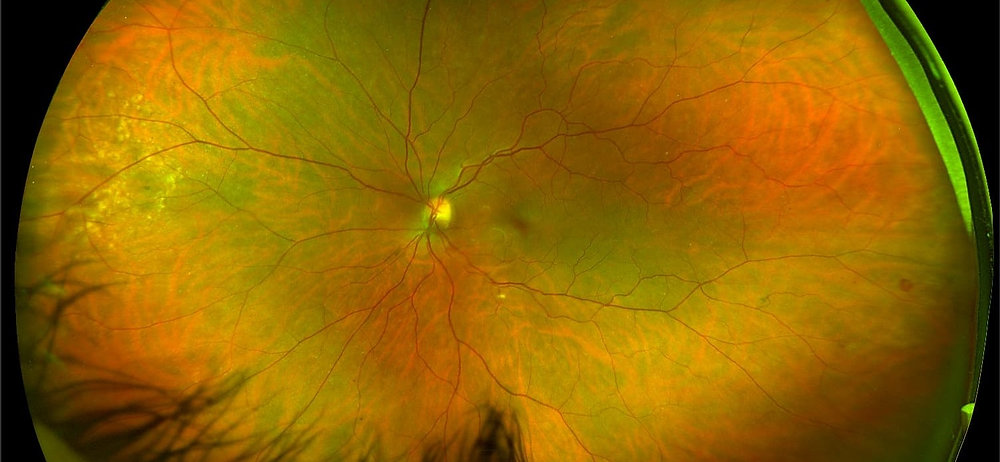 Eyes Wide Open: The Mystery Behind Dilation and Retinal Imaging