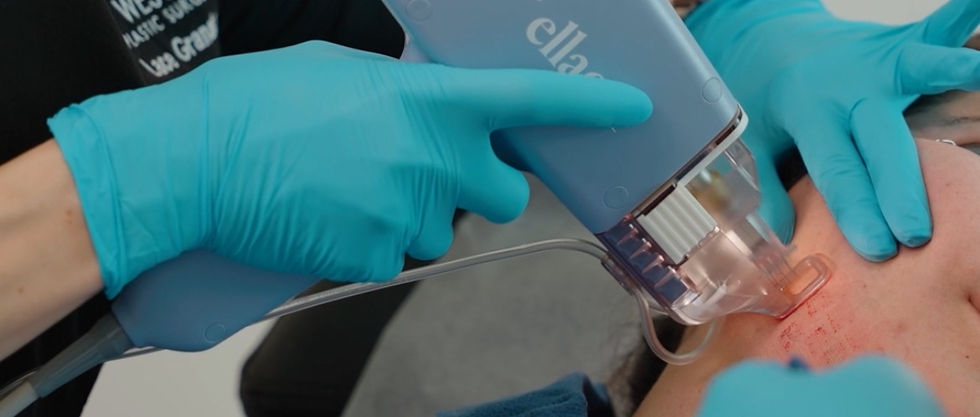 THE ART OF REJUVENATION: ELLACOR MICRO-CORING TECHNOLOGY