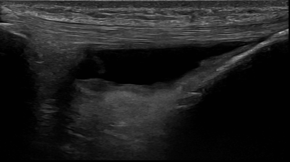Deep infrapatellar bursitis