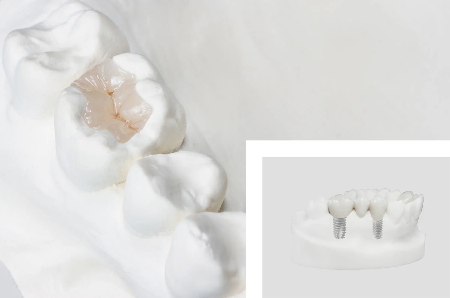 NOS PROTHESES | Dentaixel