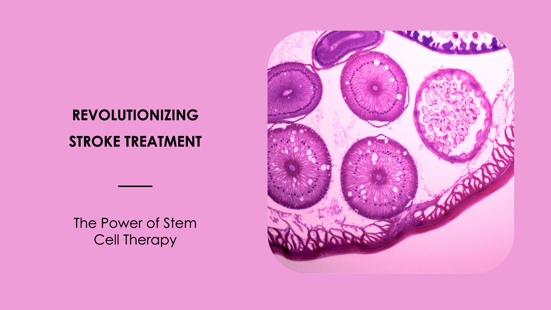 Pioneering Recovery: The Role of Stem Cell Therapy in Stroke Treatment