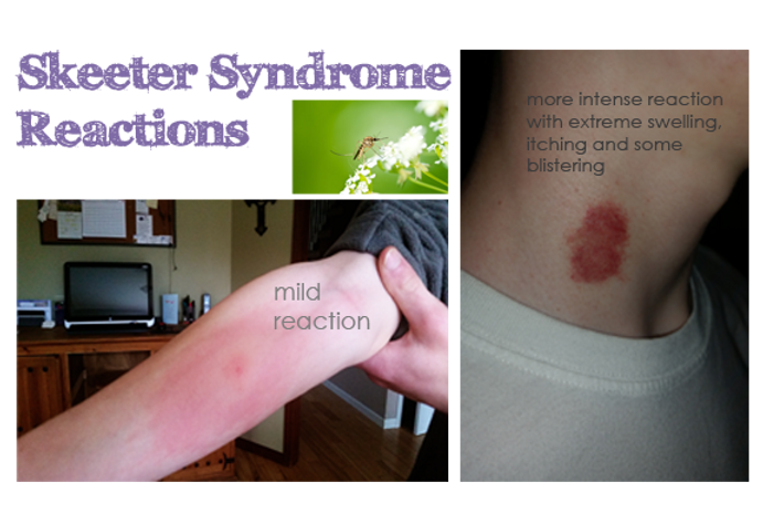 Skeeter Syndrome...What!?