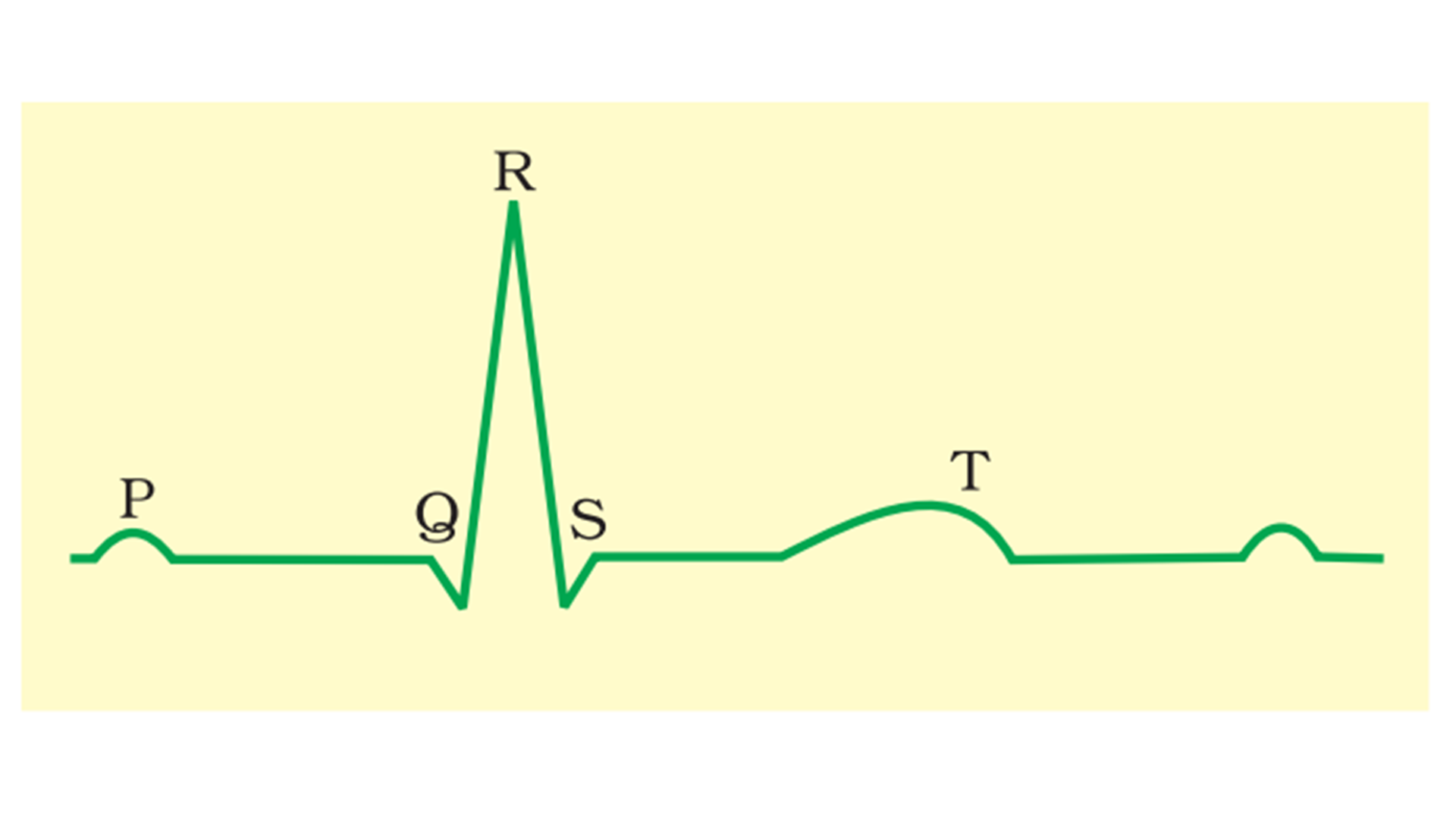Q75. The QRS complex in a standard ECG represents