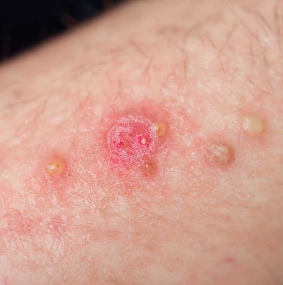 The Dangers of Picking Acne: Understanding the Consequences and Finding ...