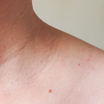 Skin Tag Removal | SKIN 101 Medspa | Spring, Texas